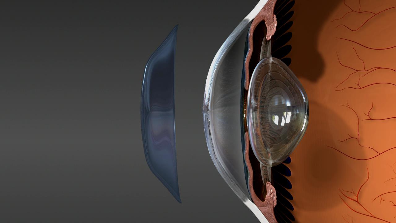 Infographic: Myopia control | OPTIMED